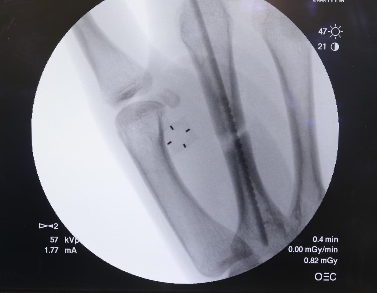 Use of NX Nail for oblique fracture fixation of 2nd metacarpal